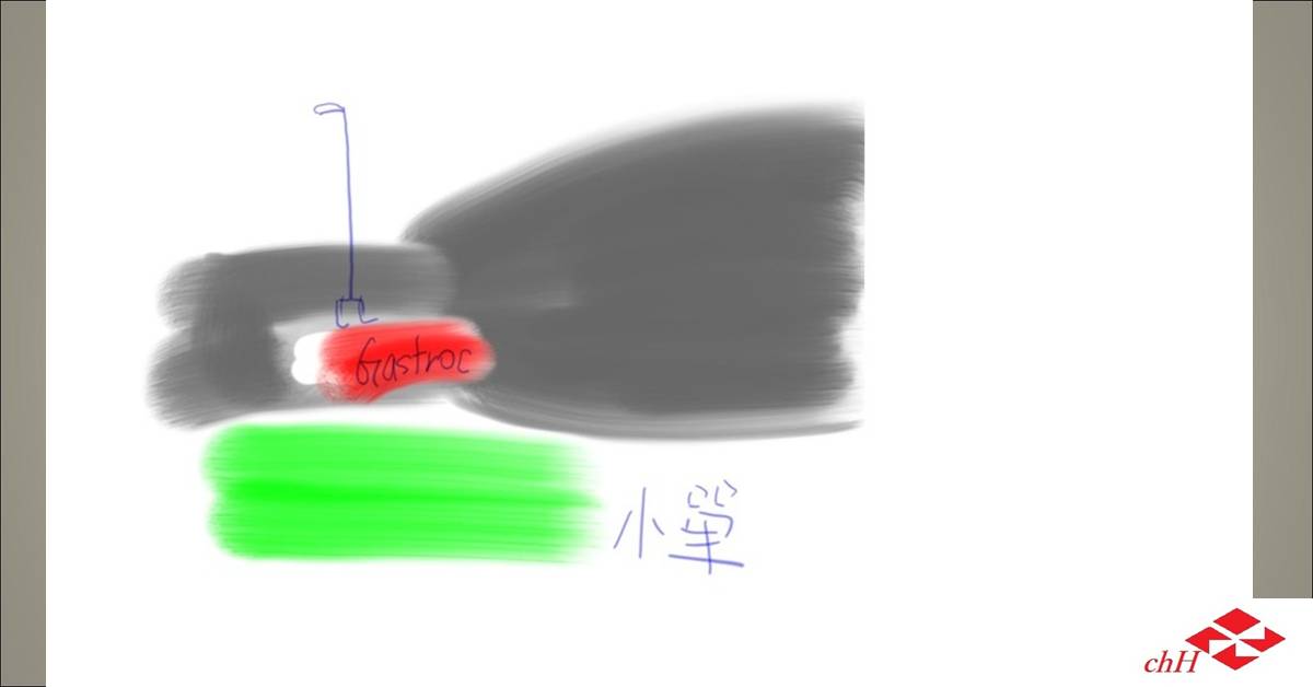 骨科醫師 謝醇樺: 小兒扁平足鬆筋手術