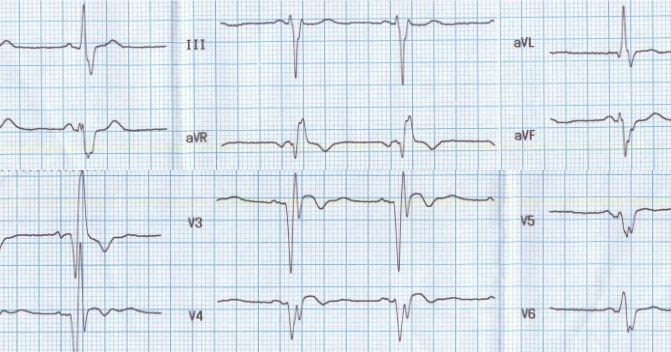 EM Didactic: The "qRBBB" pattern