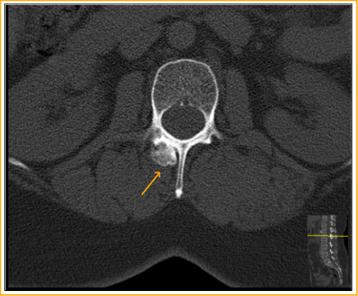 Spinous Osteochondroma-CT - Sumer's Radiology Blog
