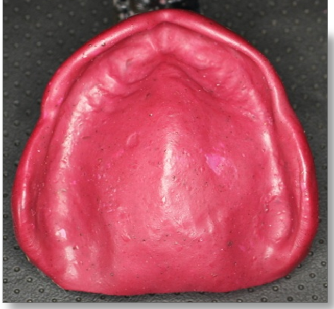 Understanding Prosthodontics - Tagore Dental College & Hospital-By ...