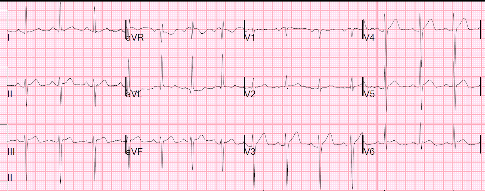 Dr. Smith's ECG Blog: LVH with expected repolarization abnormalities ...