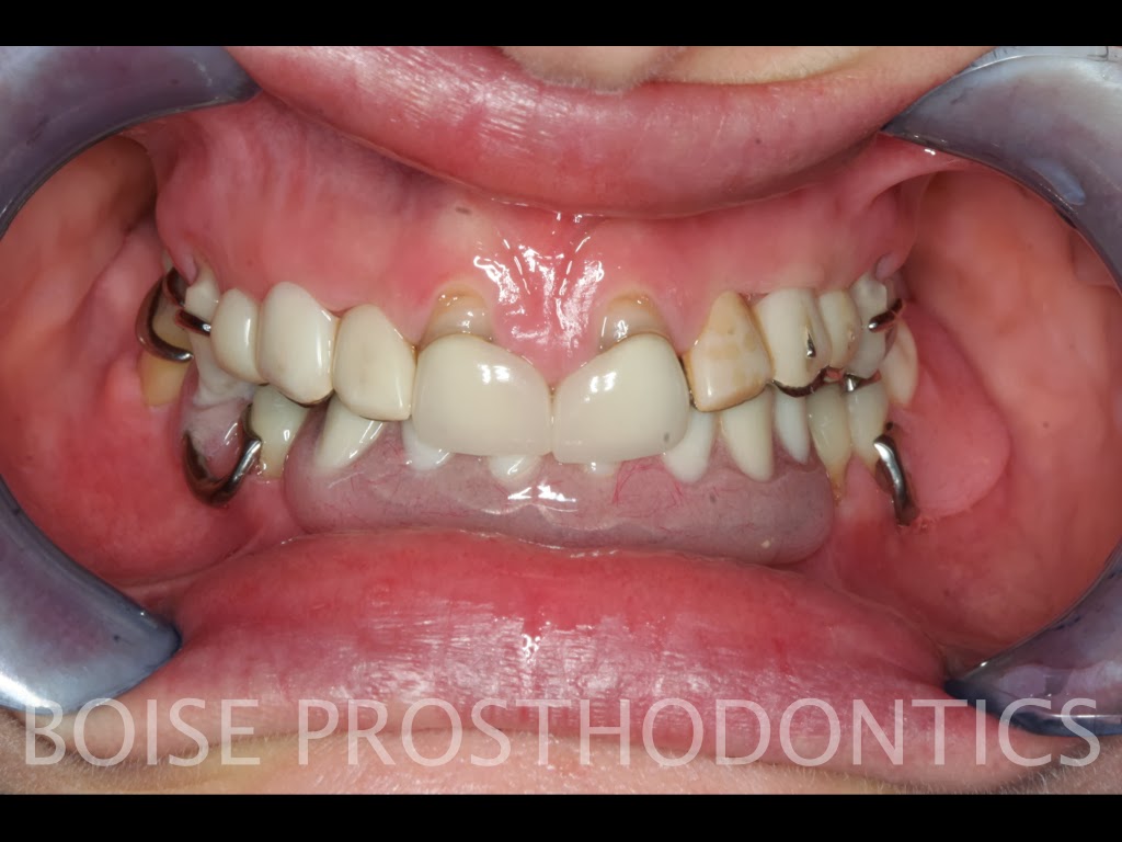 Boise Idaho Prosthodontics: Ectodermal Dysplasia: maxillary rehab ...
