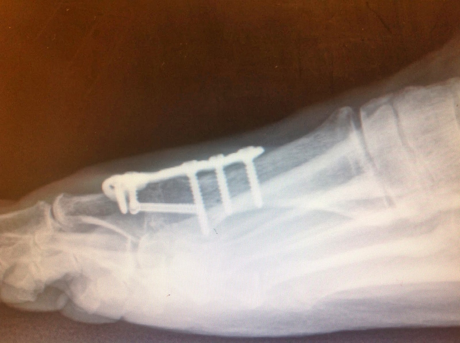 Foot and Ankle Problems By Dr. Richard Blake: Wednesday's Article of ...