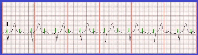 Practice EKG Rhythm Strips 200