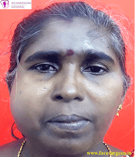 Fascial Space Infections - Richardson dental and craniofacial Hospitalposts