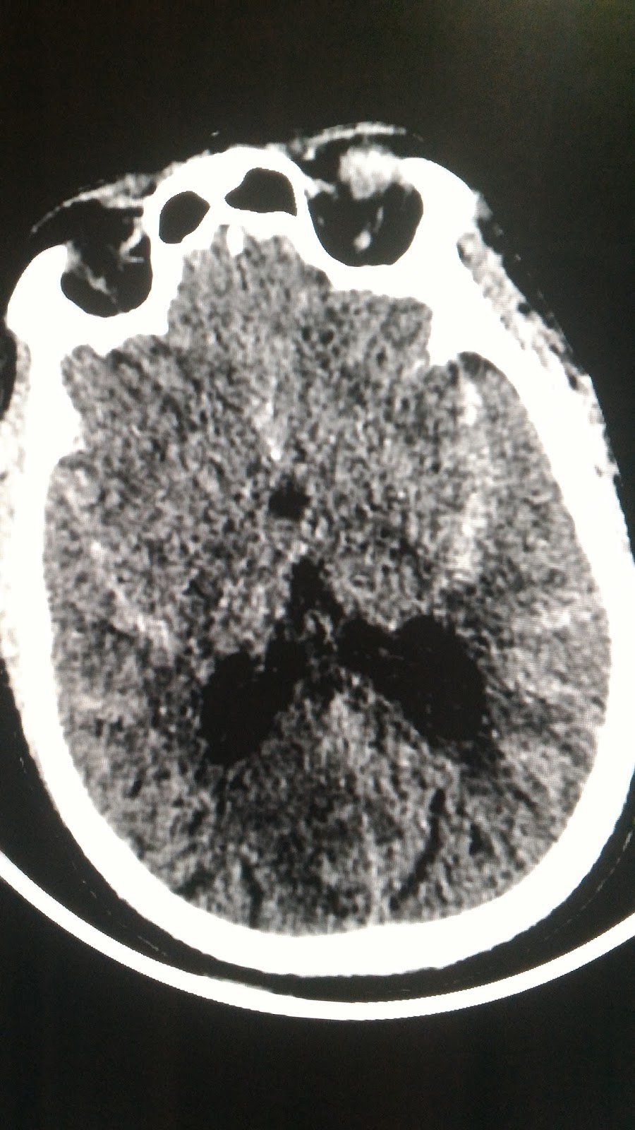 Sub Arachnoid Hemorrhage [SAH] ~ CT Brain
