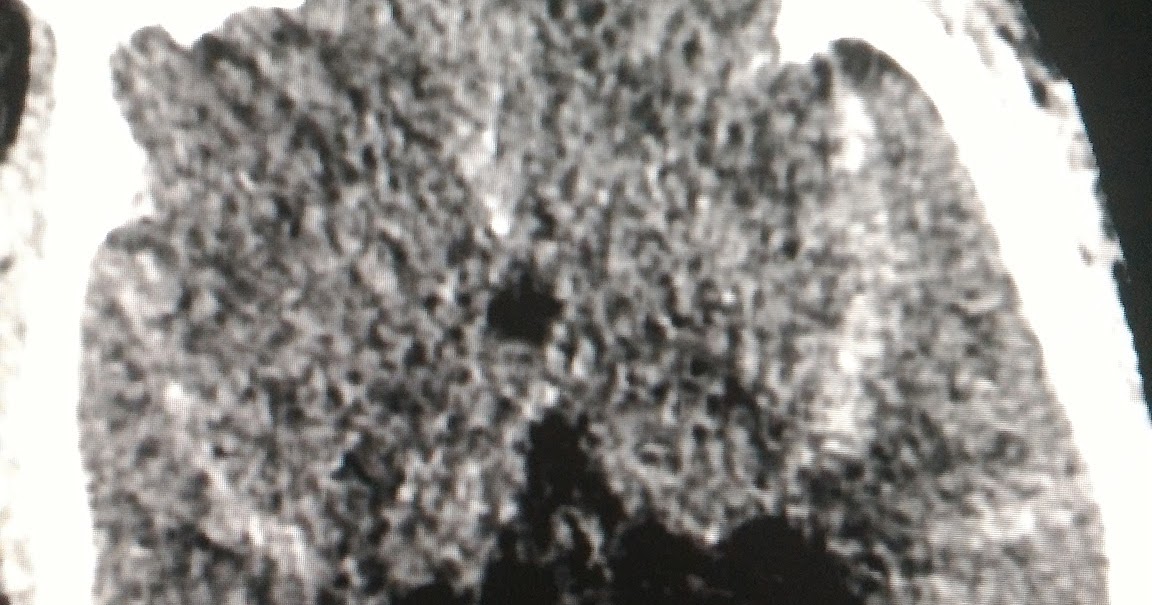 Sub Arachnoid Hemorrhage [SAH] ~ CT Brain