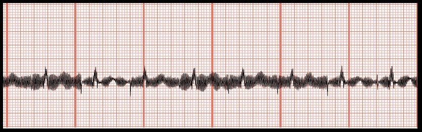 Practice EKG Strips 354