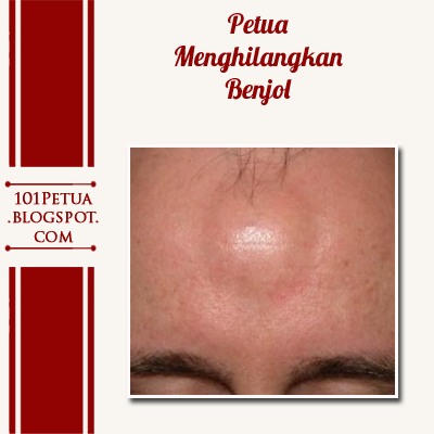 101 Petua: Petua Menghilangkan Benjol