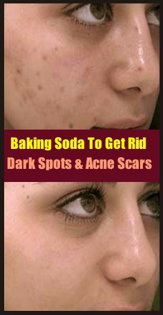 Baking Soda To Get Rid Of Dark Spots & Acne Scars