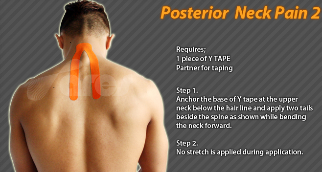 ARES Kinesiology Tape: [ARES APPLICATION] POSTERIOR NECK PAIN 2