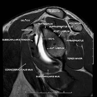 MR Arthrography Shoulder - Sumer's Radiology Blog