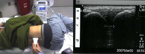 Family Medicine Topics: Ultrasound Guided Lumbar Puncture