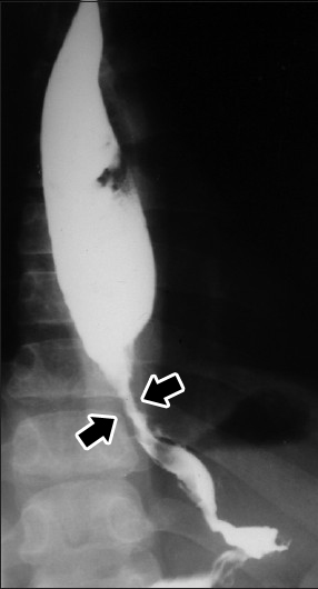 Barium swallow - cancer oesophagus
