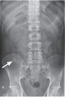ON - RADIOLOGY: Role of Abdominal X-ray in Appendicitis