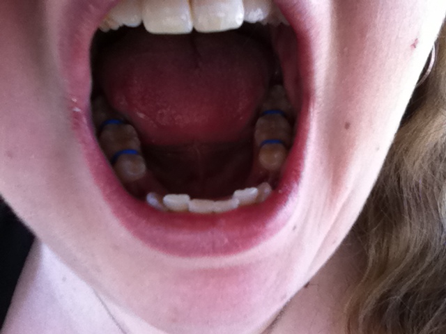 Fixing My Smile: The spacers