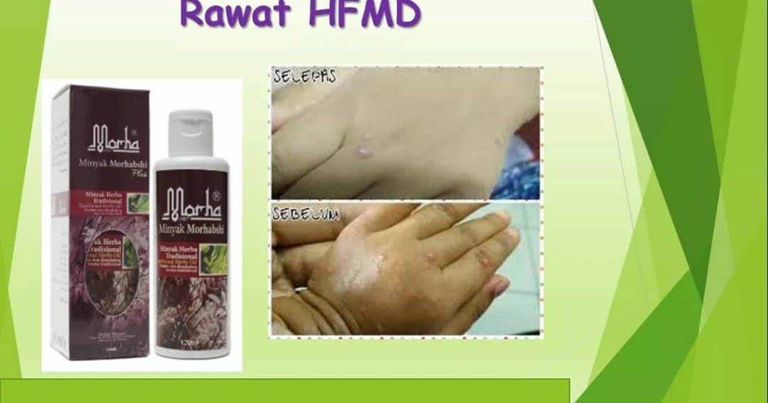 Dah ada Minyak Morha?: HFMD sakit tangan, Kaki, dan mulut