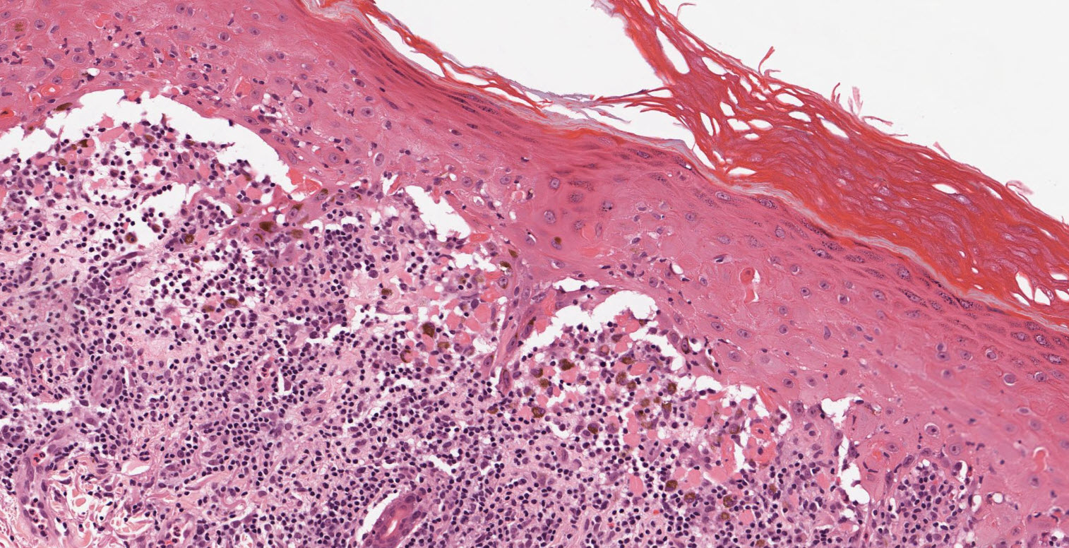 Dermoscopy Made Simple: LPLK