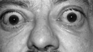 docteur: Orbitopathie endocrinienne d’origine thyroïdienne