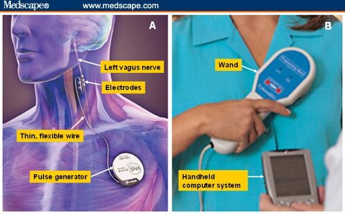 RADIANT LIGHT: Vagus Nerve Stimulator . . . VNS . . .1 Year
