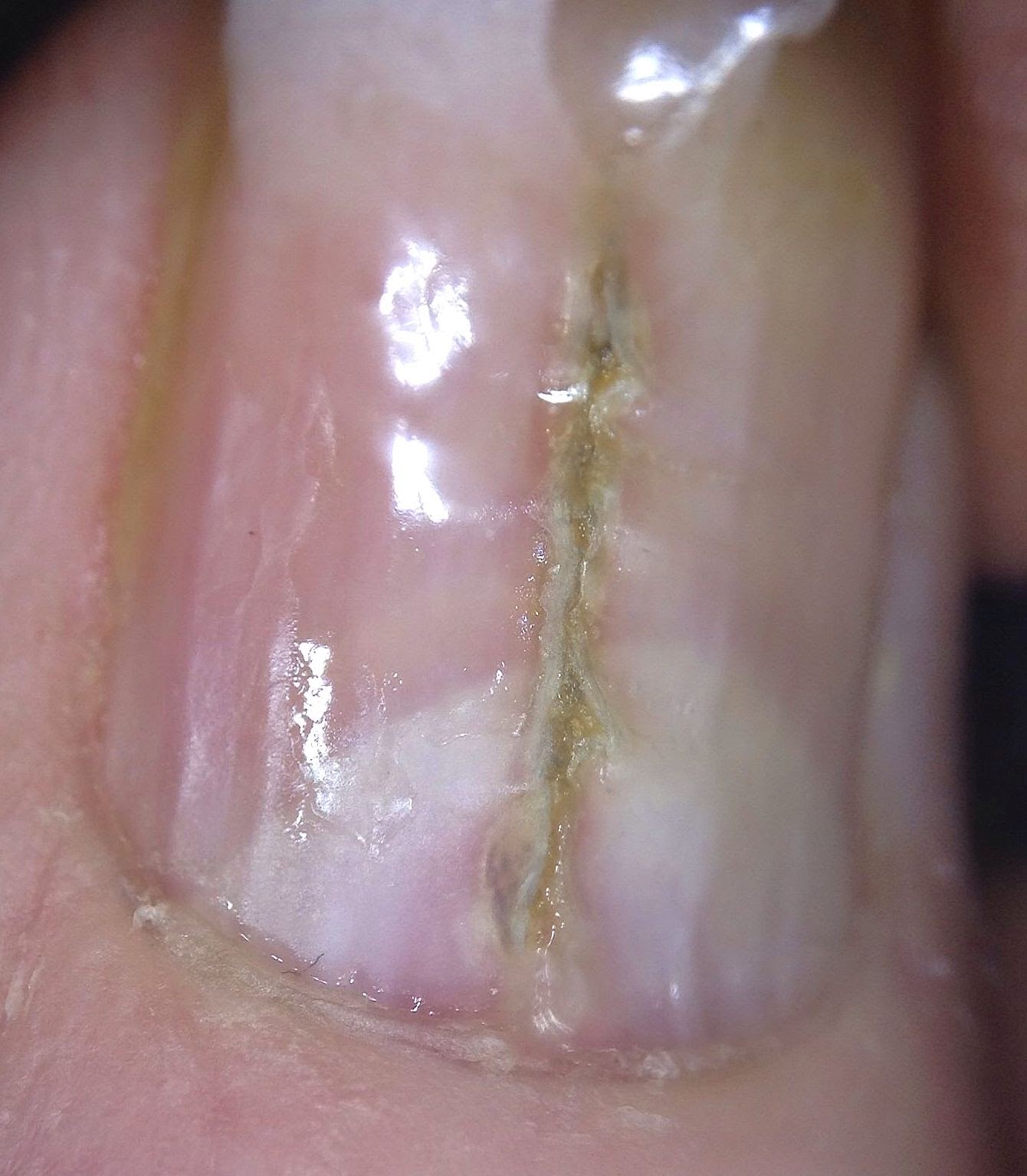 VIRTUAL GRAND ROUNDS IN DERMATOLOGY 2.0: Median Nail Dystrophy