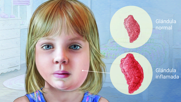 ¿Parotiditis? ¿Que es?