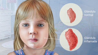 Tratamiento para la parotiditis