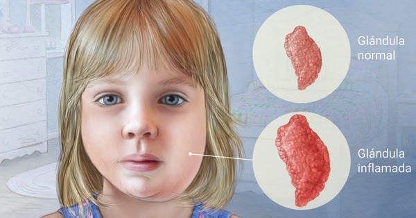 ¿Parotiditis? ¿Que es?