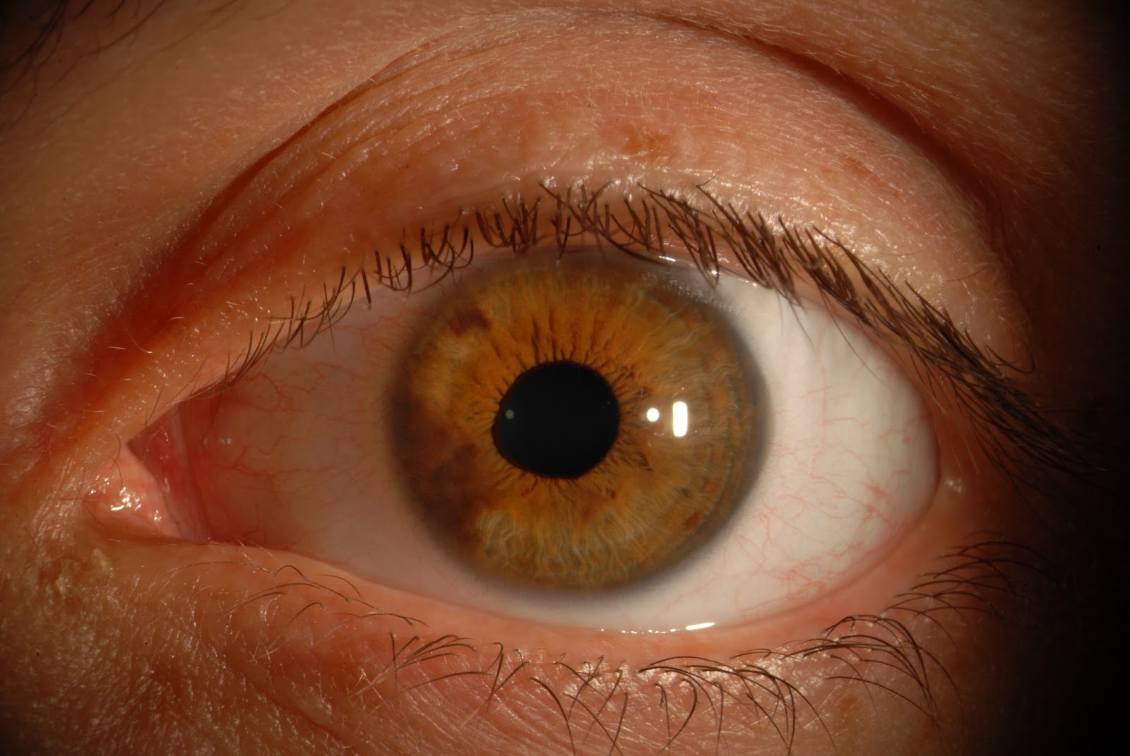 The story of my eye: Before photos (teaser)