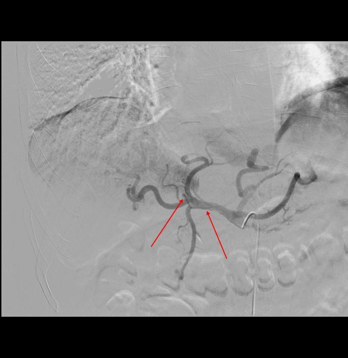 The Pump and the Tubes: Right Gastric Artery