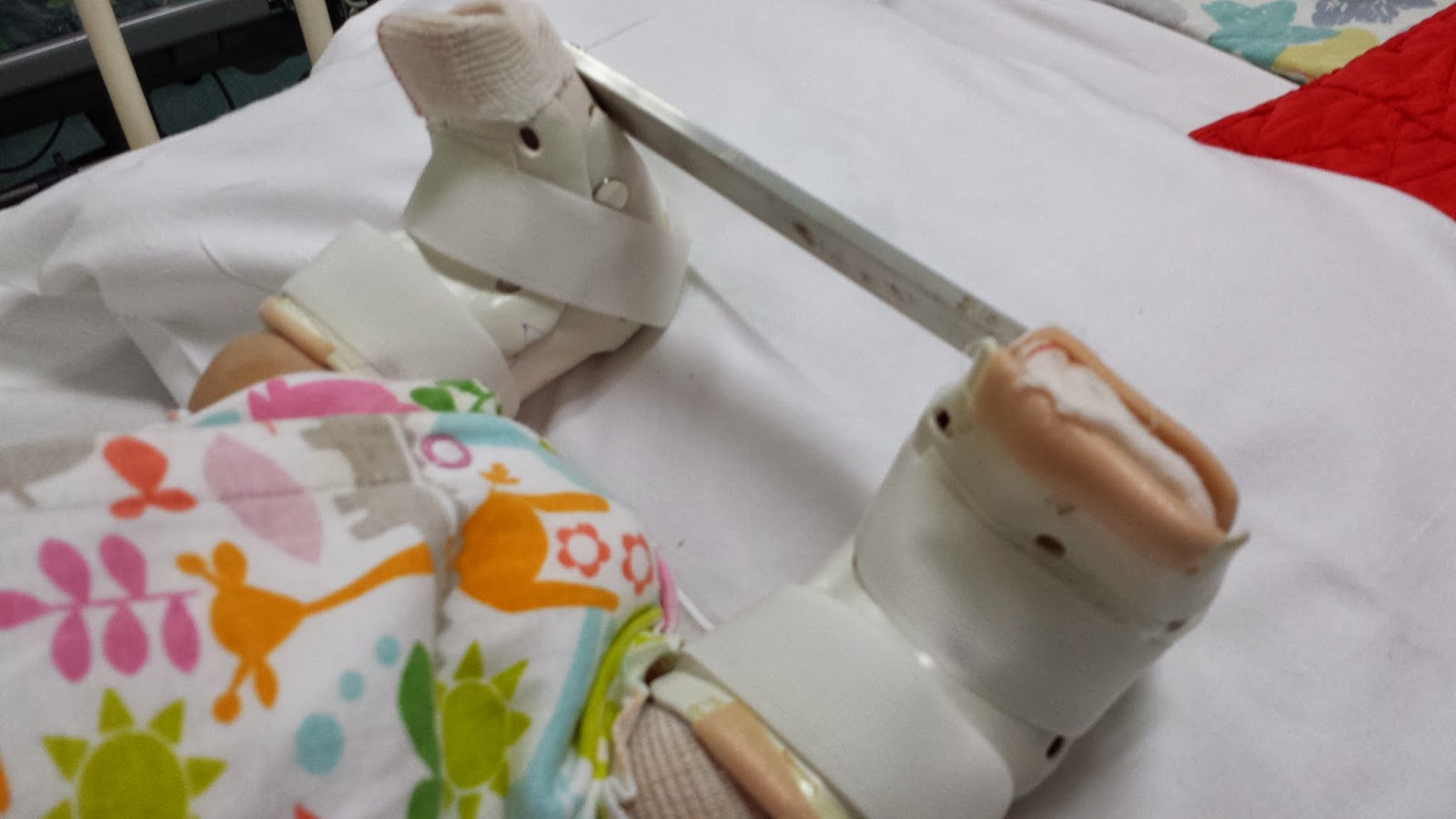 Faith, Hope and Joy: Achilles Tenotomy/Spica cast