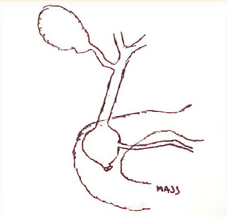 Radiology Lecture Notes: Choledochal cysts