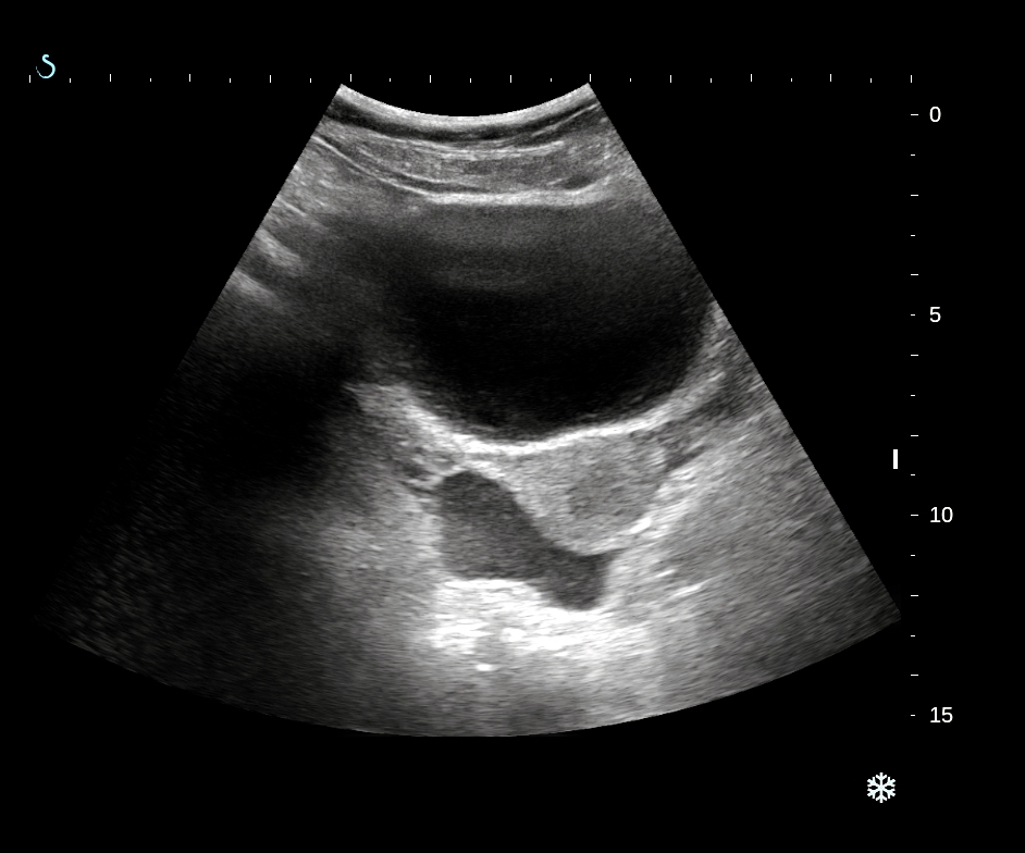 VIETNAMESE MEDIC ULTRASOUND: CASE 335: HEMOPERITONEUM, Dr PHAN THANH ...