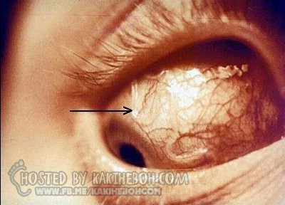 FAKTA] Cacing Yang Hidup Di Dalam Mata