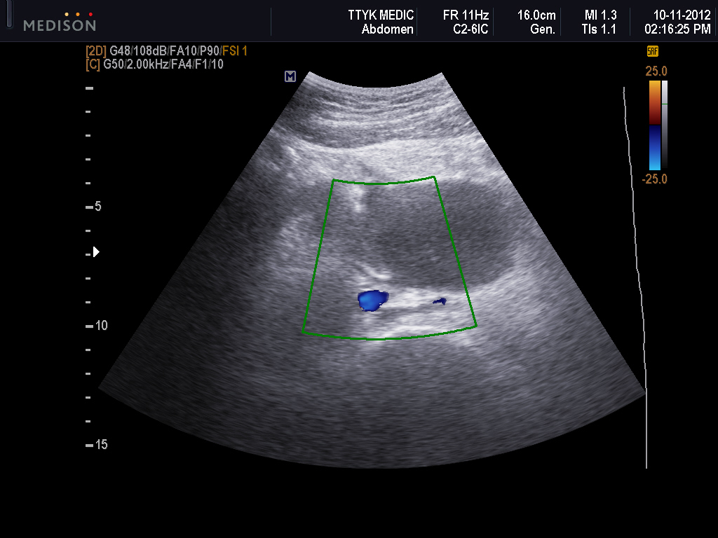 VIETNAMESE MEDIC ULTRASOUND: CASE 150: PERIUMBILICAL MASS, Dr PHAN ...