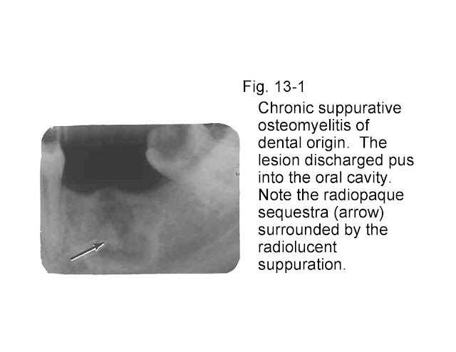 dentalaka: Osteomyelitis-with Radiological features