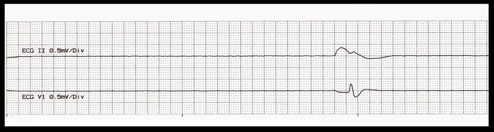 Practice EKG Strips 415