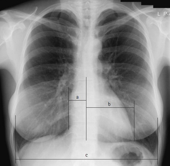 Mundo da Radiologia: Cálculo de Razão Cardiotorácica
