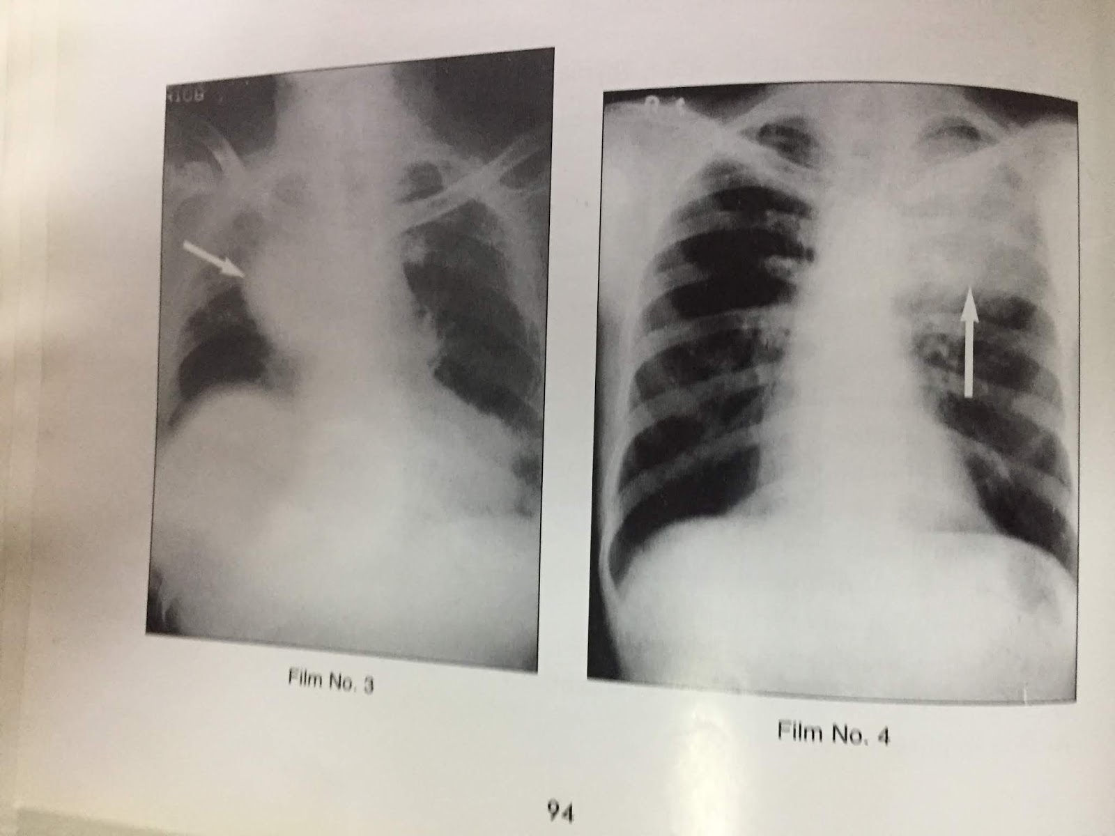 XRAYS OF THE CARCINOMA OF BRONCHUS