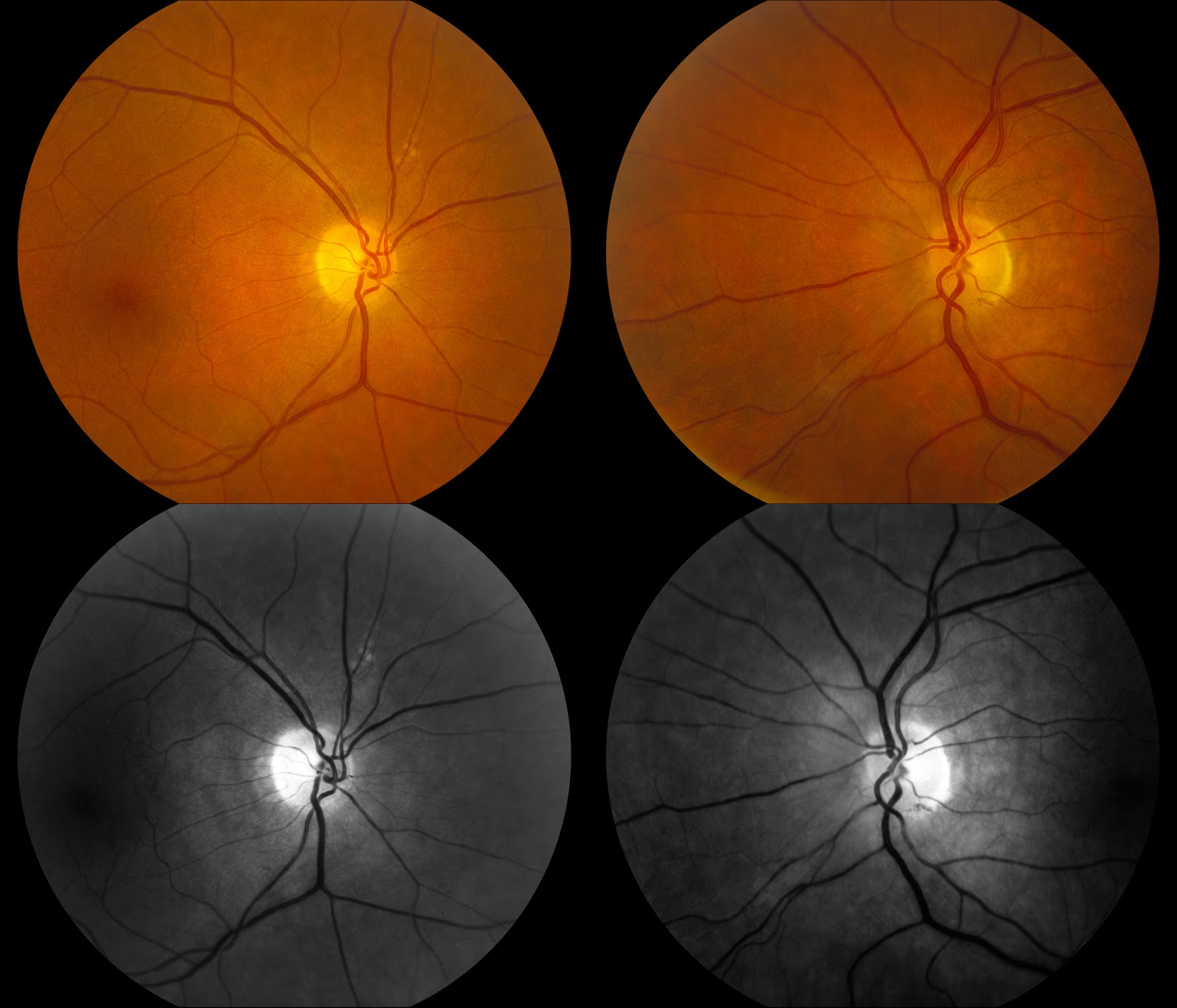 Whitman Images: RPE window defect in the right eye