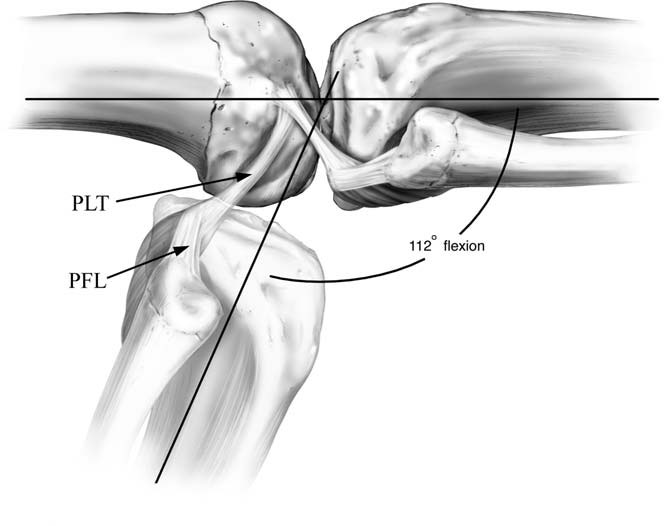 Popliteus Muscle/Popliteus Complex | Medical anatomical knowledge center