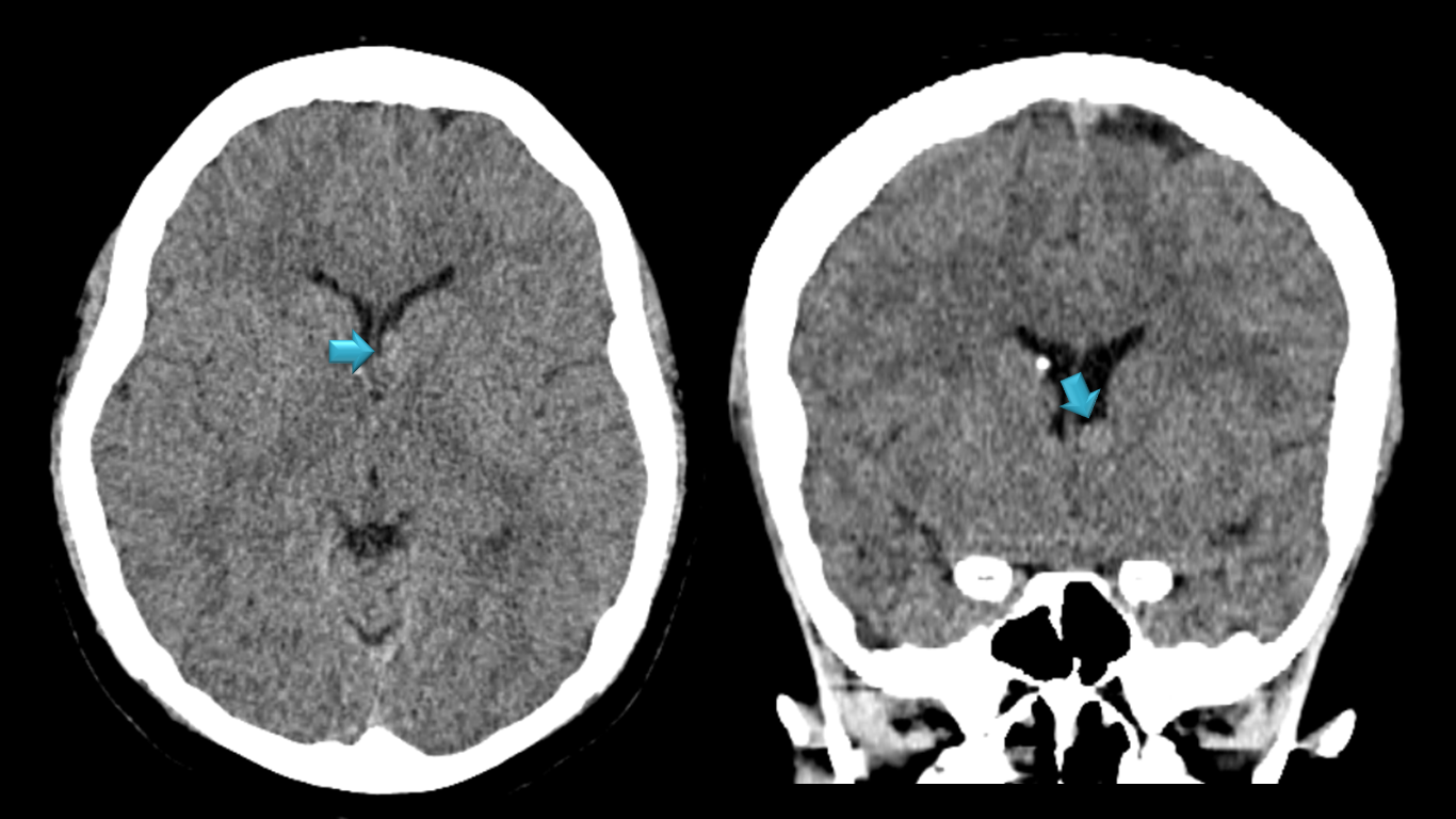 Ultimate Radiology : Plain CT Brain findings in an adolescent patient ...