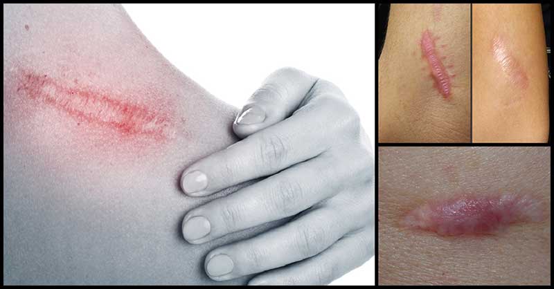 Effective Home Remedies For Keloid Scars | Dr Farrah MD