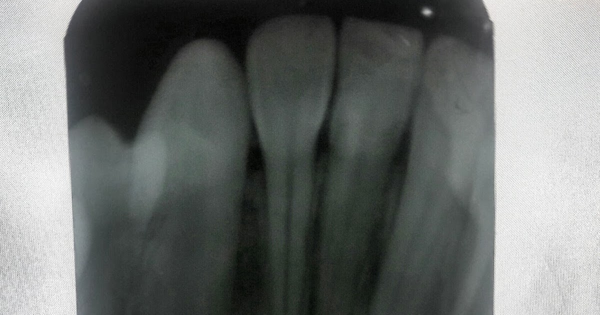 rayosxmaxilofacial: ANODONCIA DENTAL