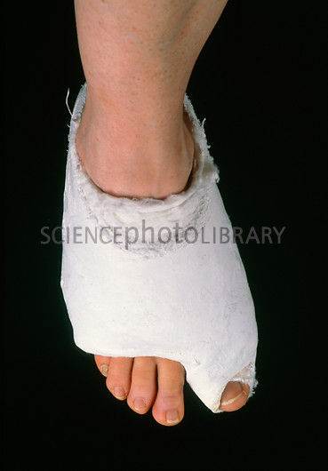 casts and feet (and more...)