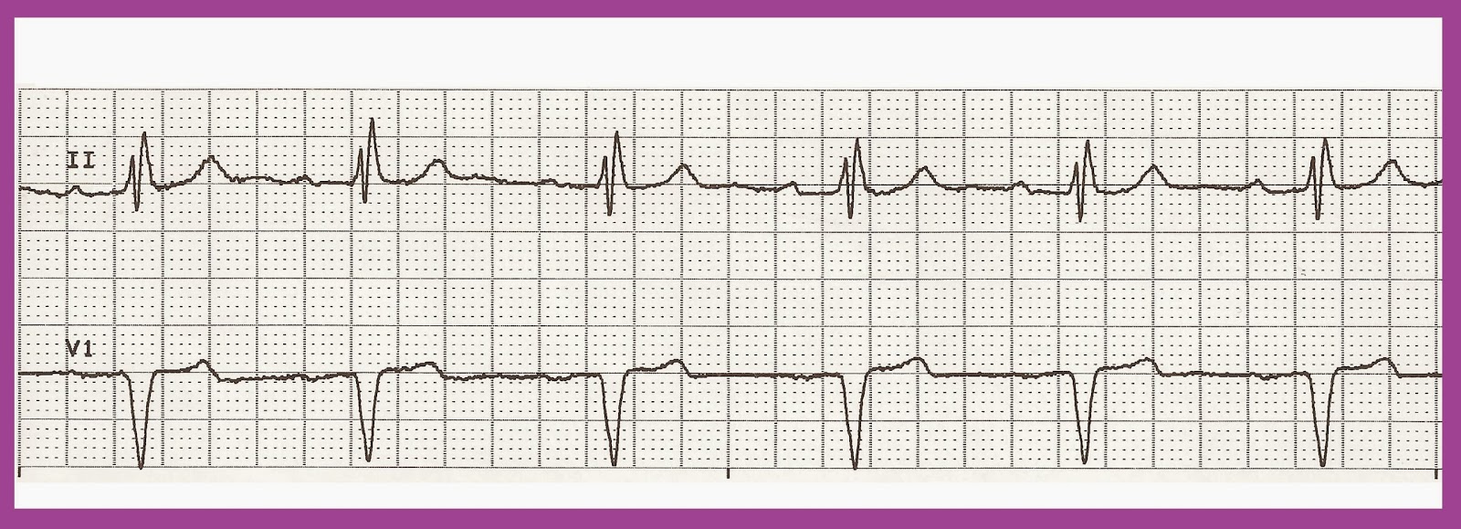 EKG Rhythm Strip Quiz 207