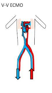 ECMO（PCPS）の基本原理と観察項目-臨床工学技士による呼吸療法勉強会