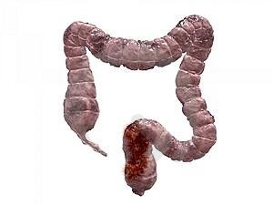 Programas Nutricionales Para:: ¿Puede la Muerte Comenzar En El Colon?