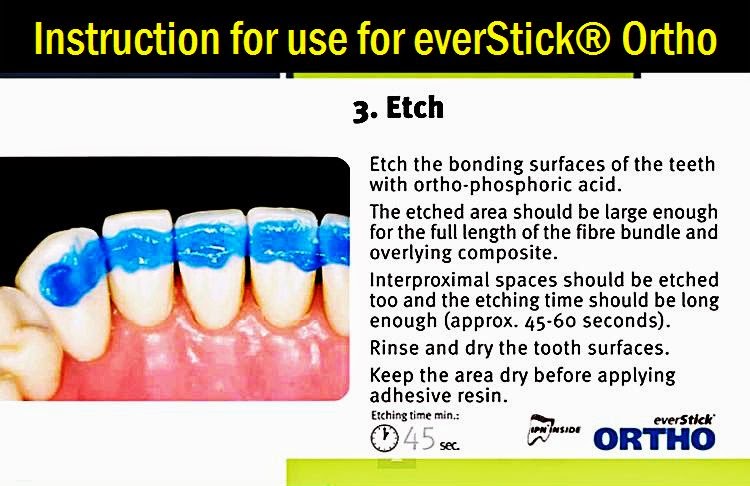 DENTAL MATERIALS: Instruction for use for everStick® Ortho - Odonto-Tv