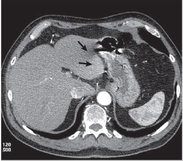 CT Scan Artifacts - RadTechOnDuty